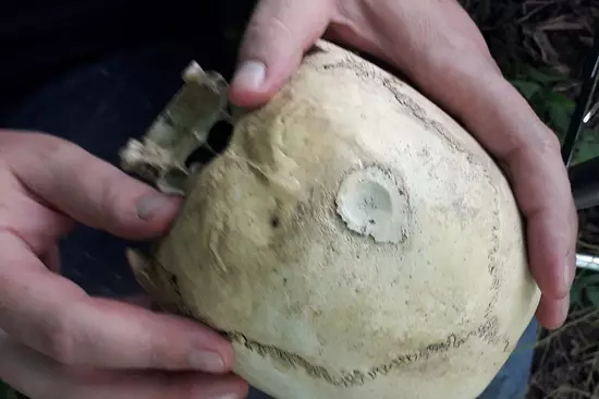 Foto número 1 - Em Ingusedia, Arqueólogos encontraram um crânio com traços de trepanação