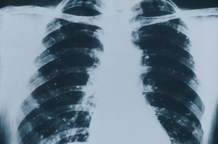 عکس №1 - ظرفیت حیاتی: 7 حقایق در مورد ریه ها