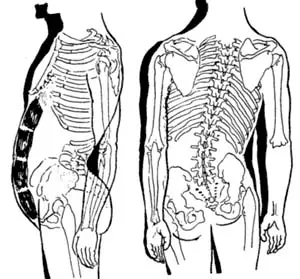 ඡායාරූපය №1 - පිළිගත් ජාන ස්කොලියෝසිස්