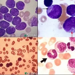 Inombolo yefoto 1 - Uhlobo lweGene wabangela i-leukemia