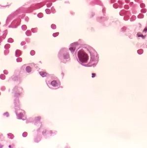 Nọmba fọto 1 - Herpes jẹ jẹbi ni awọn ọpọlọ ọpọlọ