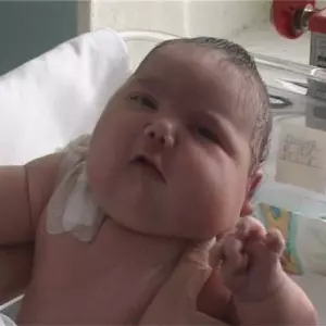 Fotografija №1 - dekle se je rodila s težo približno 8 kg