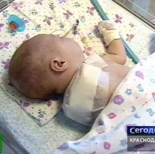 Fotoğraf №1 - Doktorlar iki aylık bir kızın ellerini mahrum etti