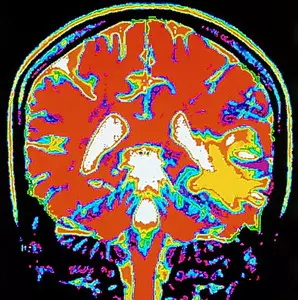 Photo №1 - Brain will restore after stroke